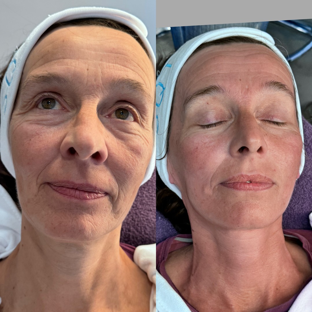 SQT antiaging - Luma Medic, Zagreb Tretman lica #W9Y225 - SrediMe